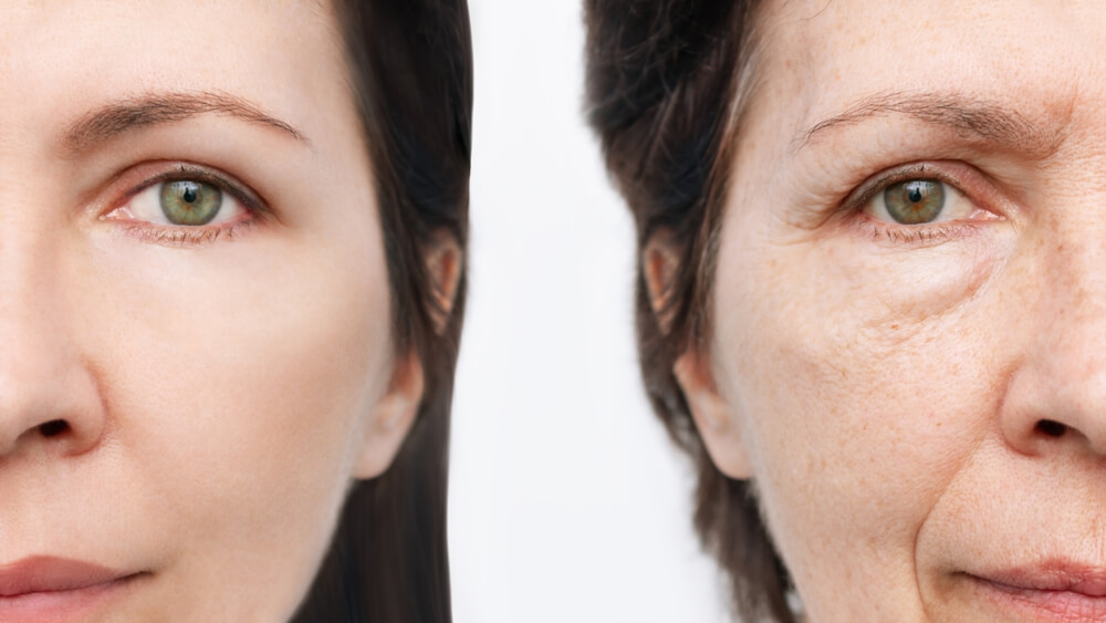 What Is A Liquid Facelift And How Does It Work? - Dr. Bret Johnson