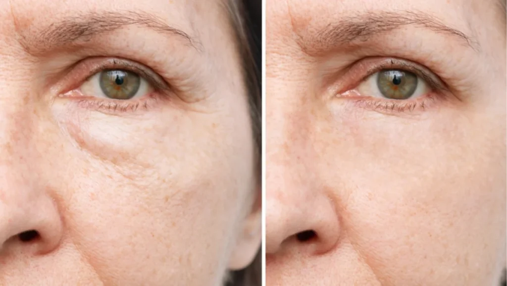 What To Expect Before And After Under Eye Filler?
